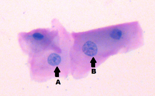 nuclear abnormalities