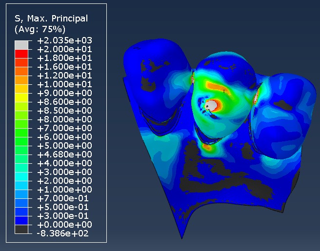 3d Teeth Model With Viscoelastic Periodontal Ligament Finite Element