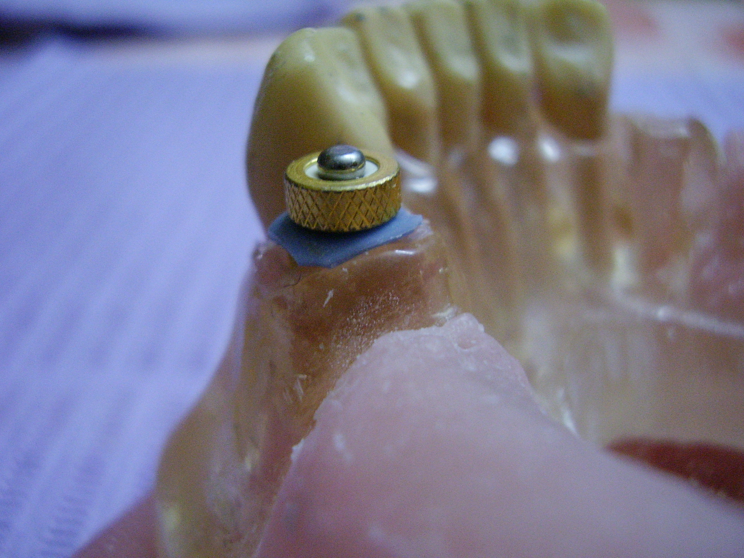 Bilateral Distal Extension Removable Partial Overdenture Retained by O ...