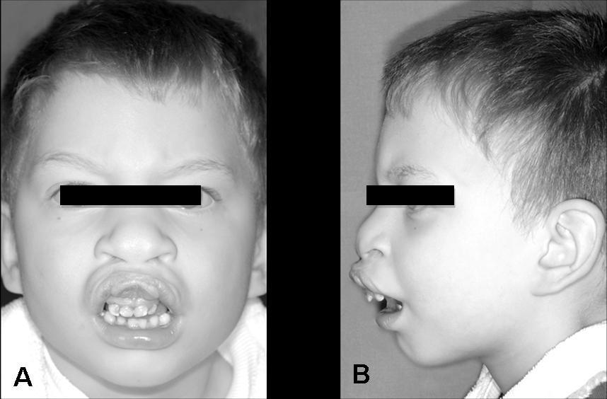 The Special Value of the Magdeburg Palatal Distractor for the ...
